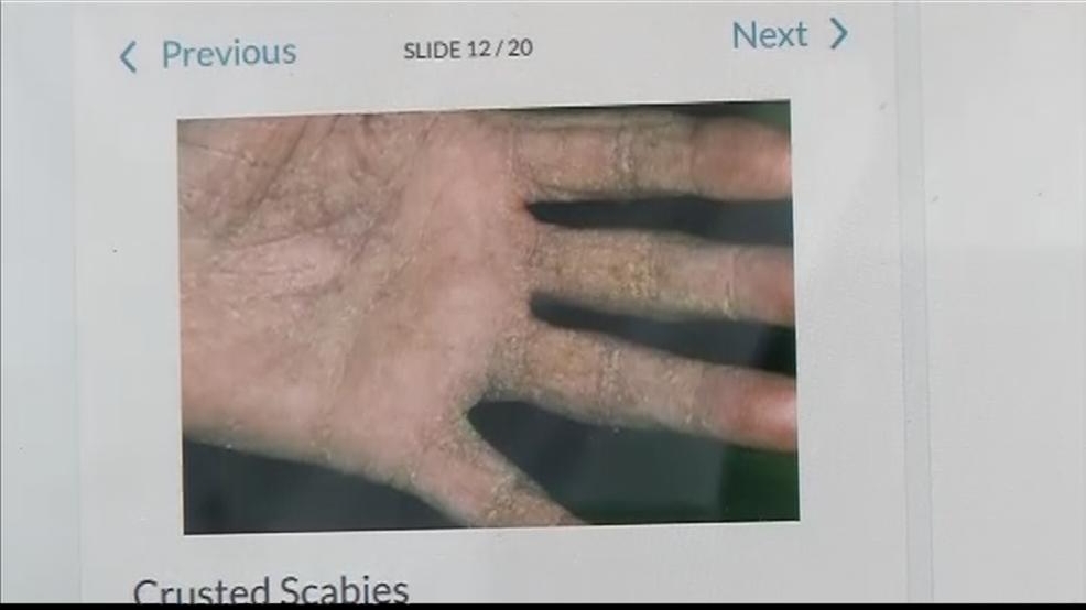 Logan County health officials concerned about crusted scabies | WSYX